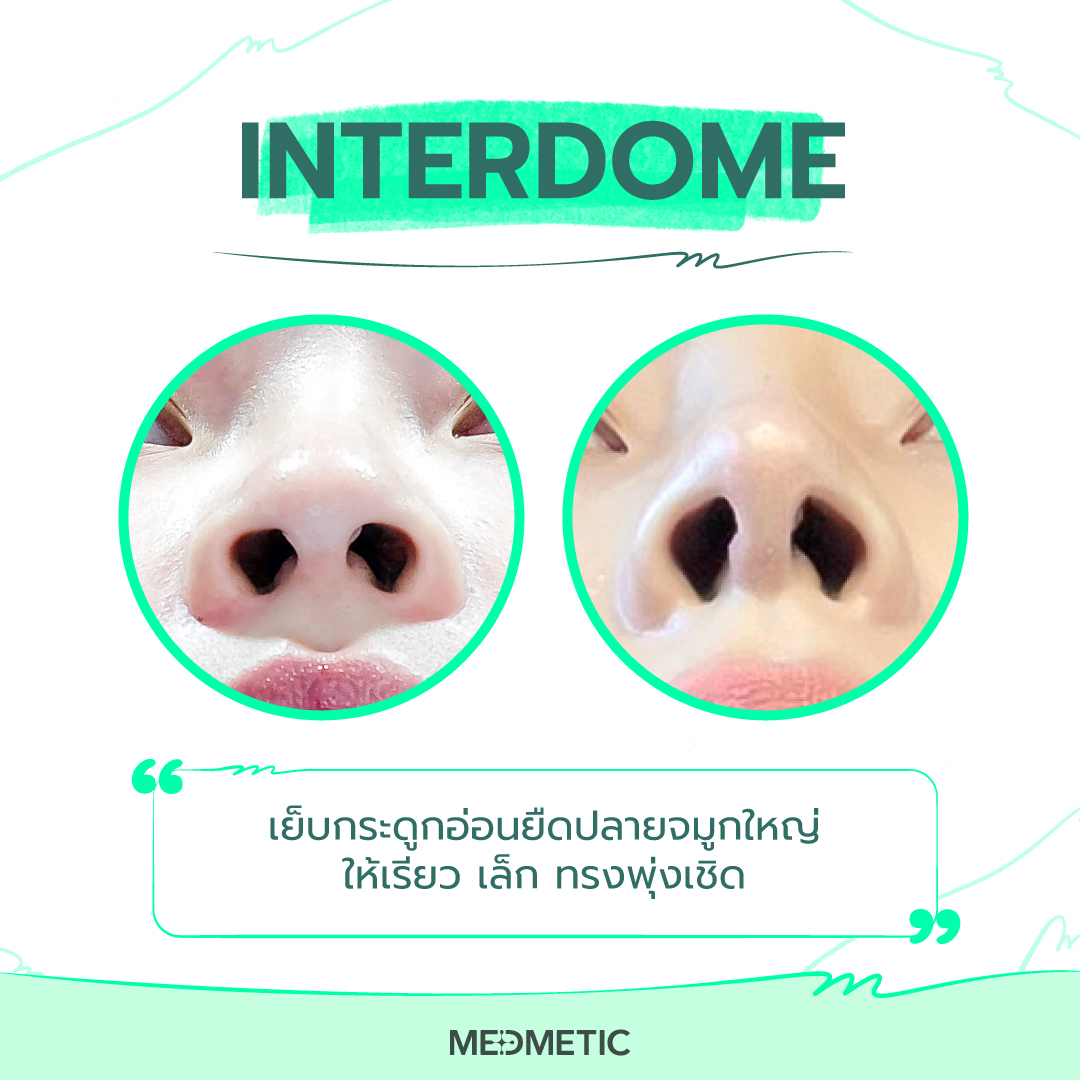 เจาะลึก หน้าแบบใดที่เหมาะกับจมูกทรงหยดน้ำ พร้อมรีวิวหลังทำ – MedMetic
