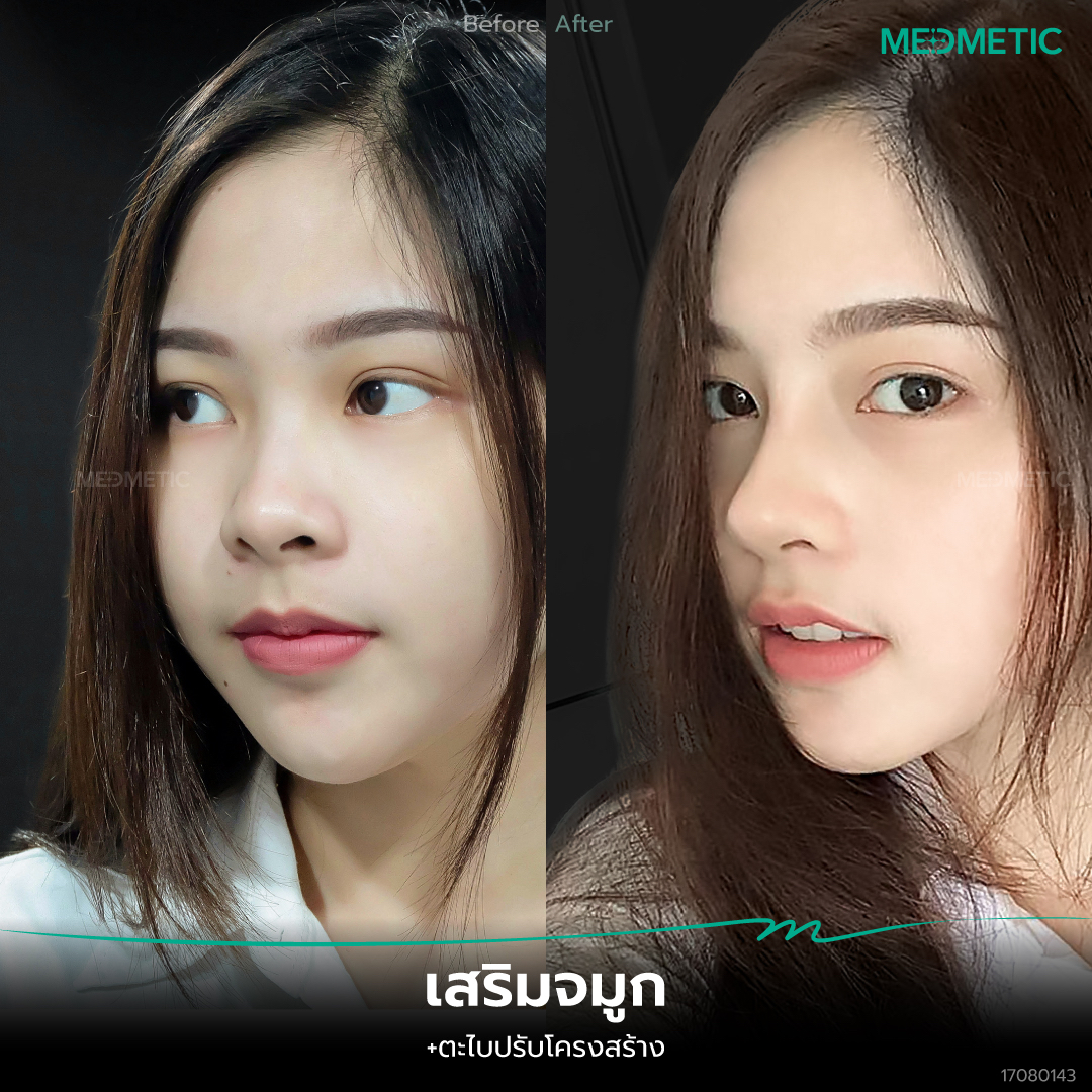 เจาะลึก หน้าแบบใดที่เหมาะกับจมูกทรงหยดน้ำ พร้อมรีวิวหลังทำ – MedMetic